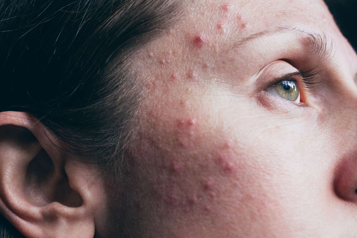 What Causes Acne and How Can You Prevent It - Always First