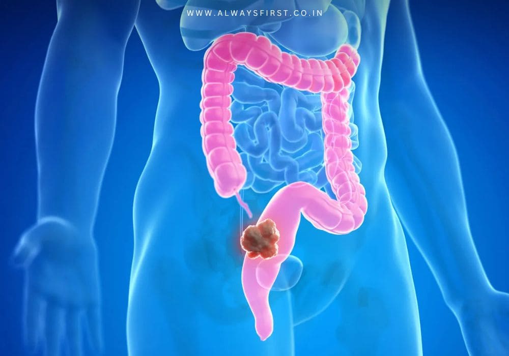 Colon Cancer Spikes in Young Adults: 5 Critical Warning Signs - Always ...